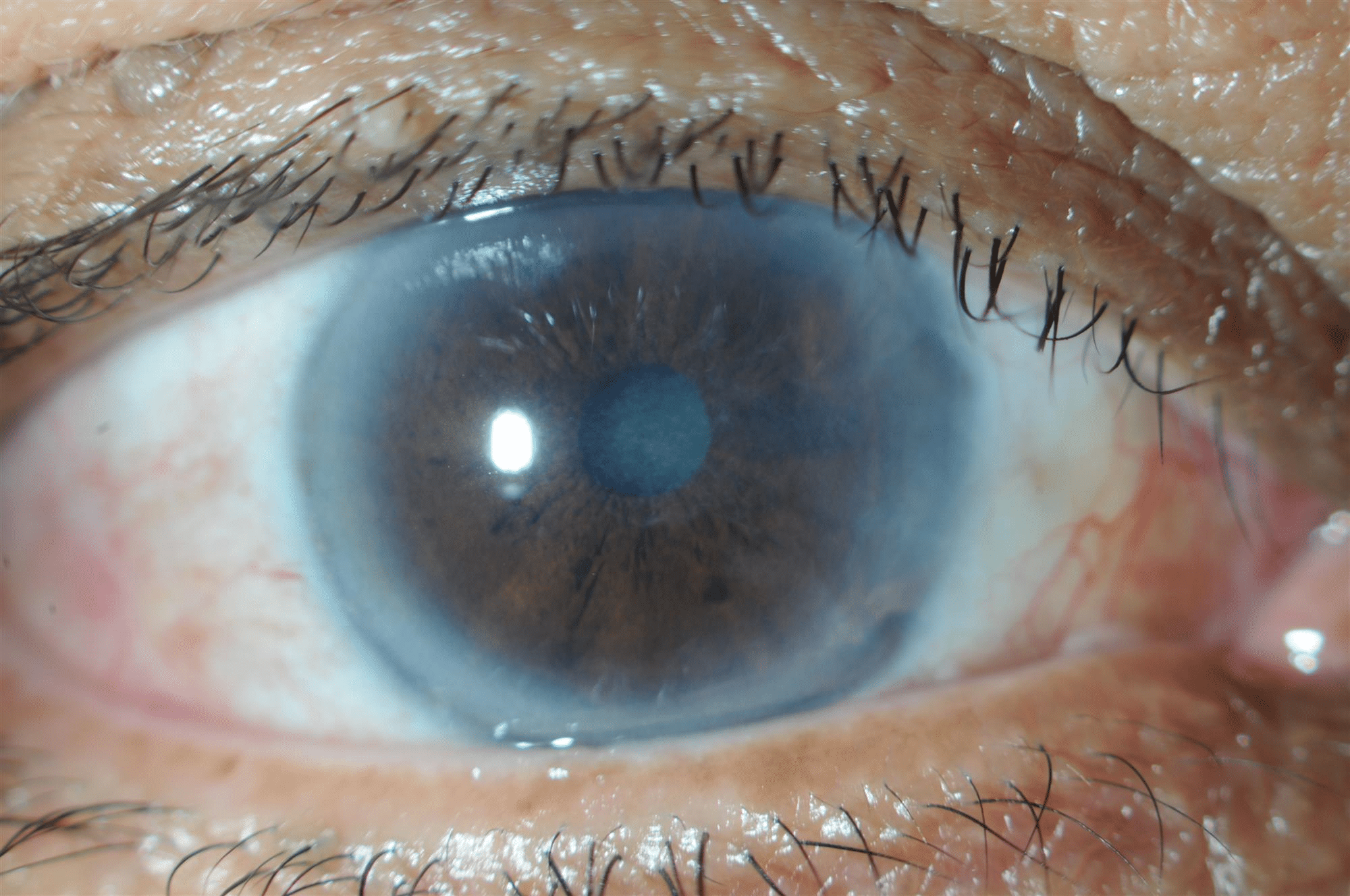 What is a pinguecula? What is a pterygium? - Mark C. Vital, M.D.
